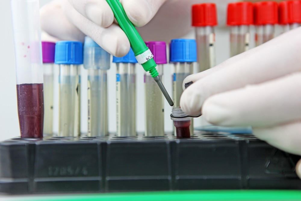 Un test de sange ar putea prezice succesul tratamentului pentru ...